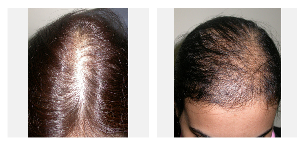 Hair Restoration Women Beirut Lebanon Hair Restoration Women Beirut Lebanon